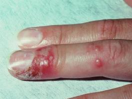 UNHEIRO: Causas, Sintomas e Como Curar